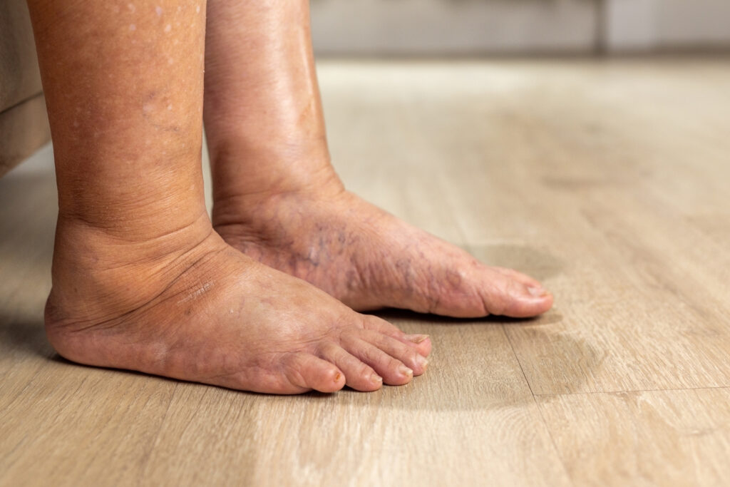 Inchaço nas Pernas: Causas e Quando se Preocupar – Clínica Saúde ...